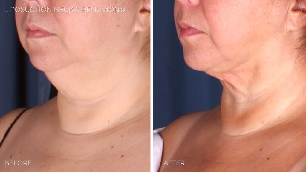 Neck Lift Alternatives: Surgical & Non-surgical Options | Omaha ...